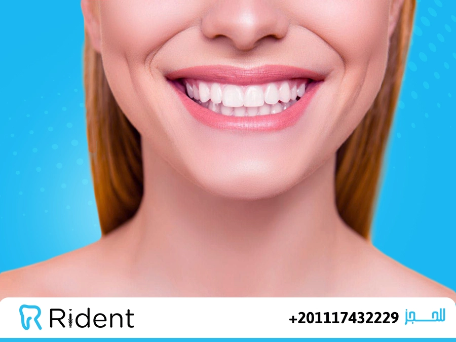 تكلفة ابتسامة هوليود Rident Dental Centers